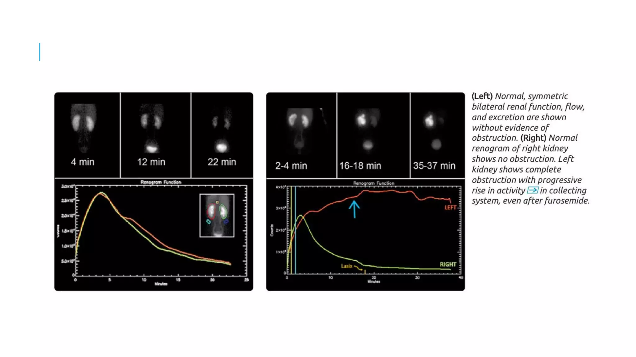 Renal scintigraphy - Nuclear Medicine- Genitourinary | PDF
