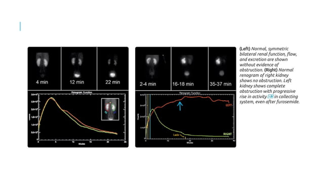 Renal scintigraphy - Nuclear Medicine- Genitourinary | PDF | Digestive ...