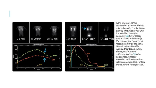 Renal scintigraphy - Nuclear Medicine- Genitourinary | PDF | Digestive ...