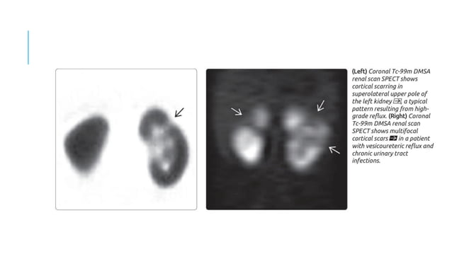 Renal scintigraphy - Nuclear Medicine- Genitourinary | PDF | Digestive ...