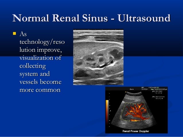 Renal Sinus Location