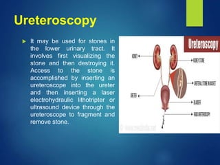 Renal stone | PPTX