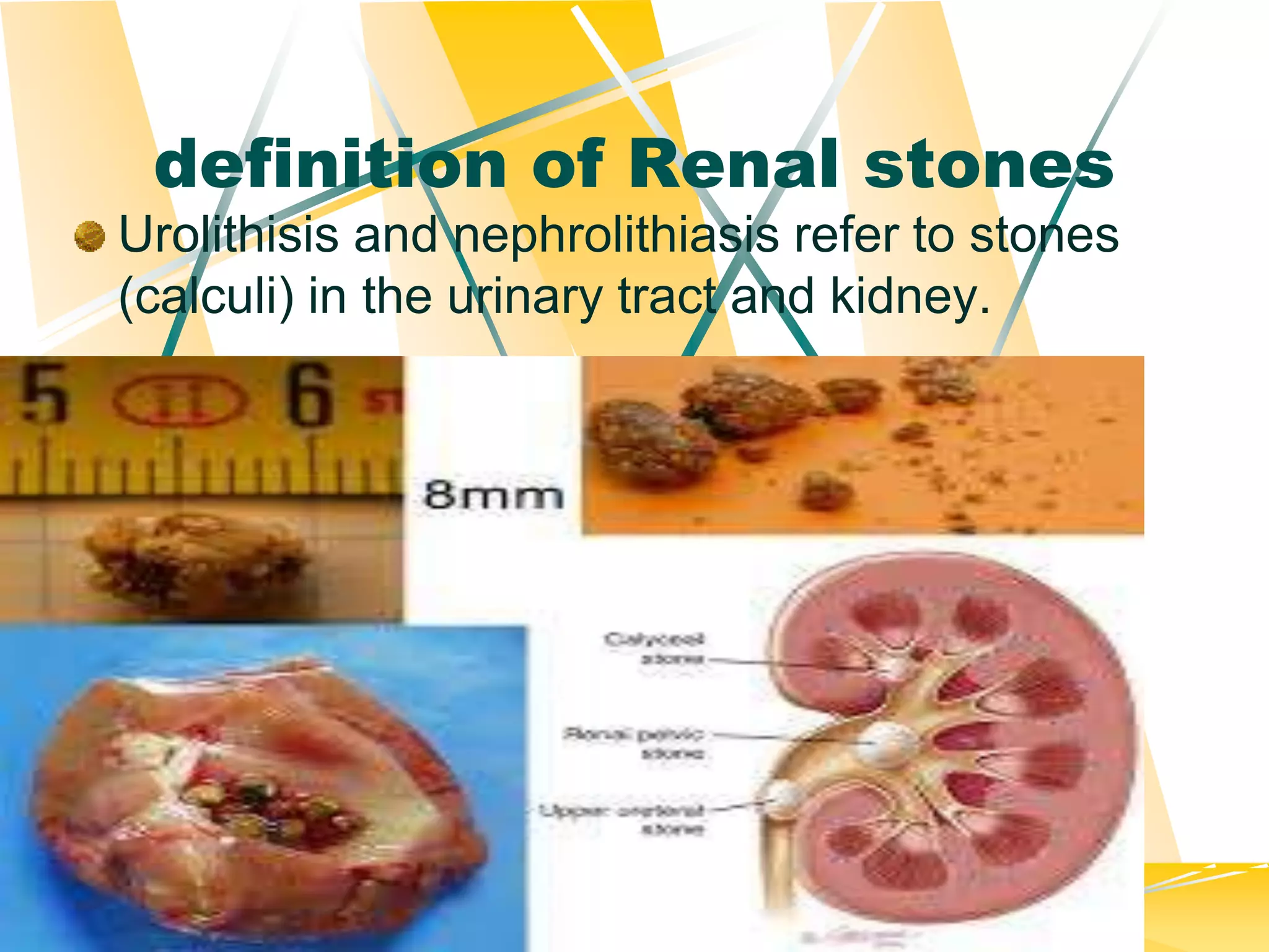 Renal stones | PPTX