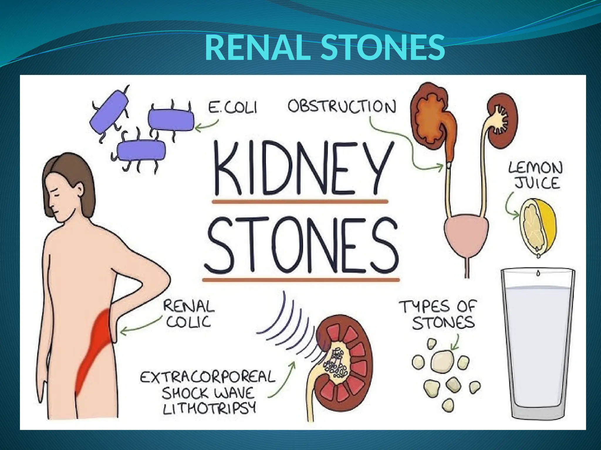 RENAL STONES,Definition types,causes ,risk factor | PPTX