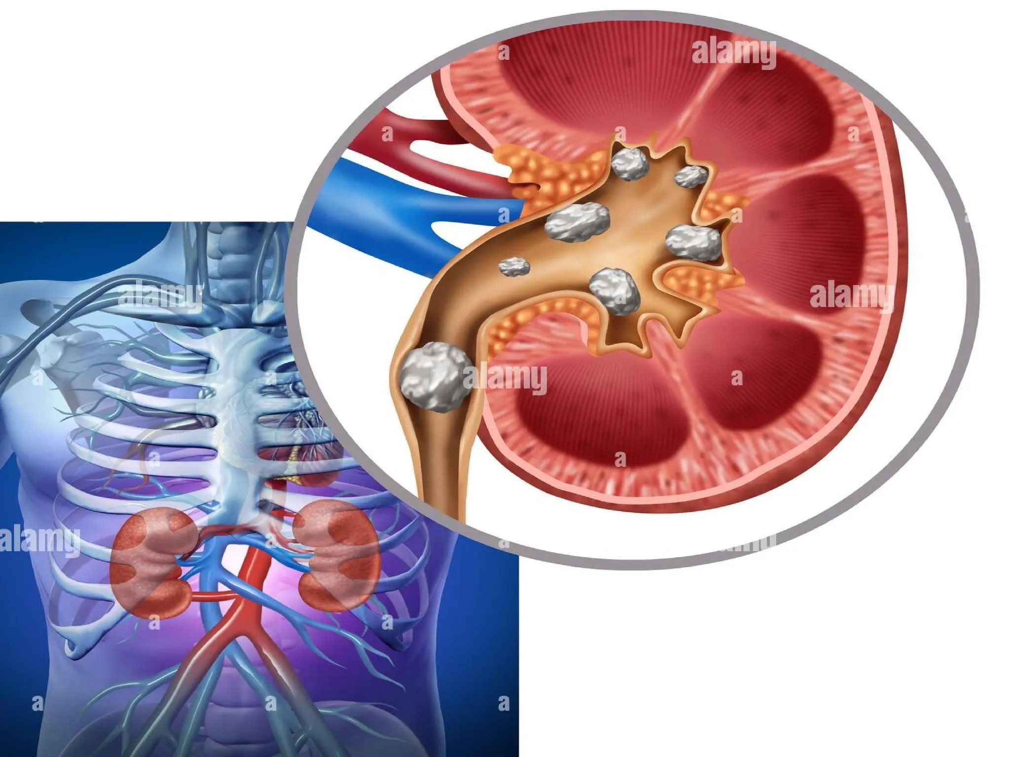 RENAL STONES,Definition types,causes ,risk factor | PPTX