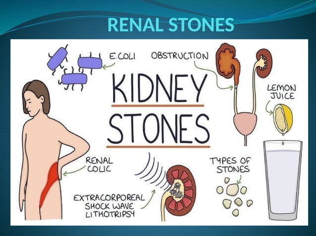 RENAL STONES,Definition types,causes ,risk factor | PPT