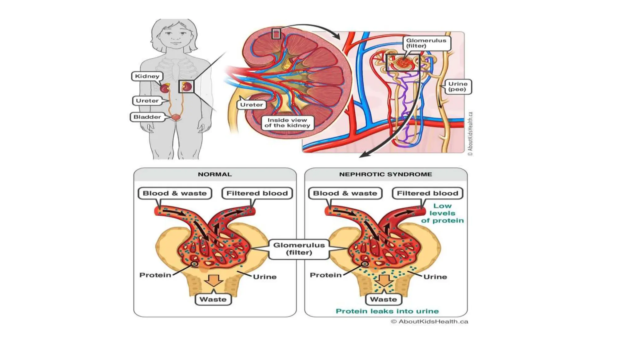 renal system disorders.pptx essential informations are involved | PPTX