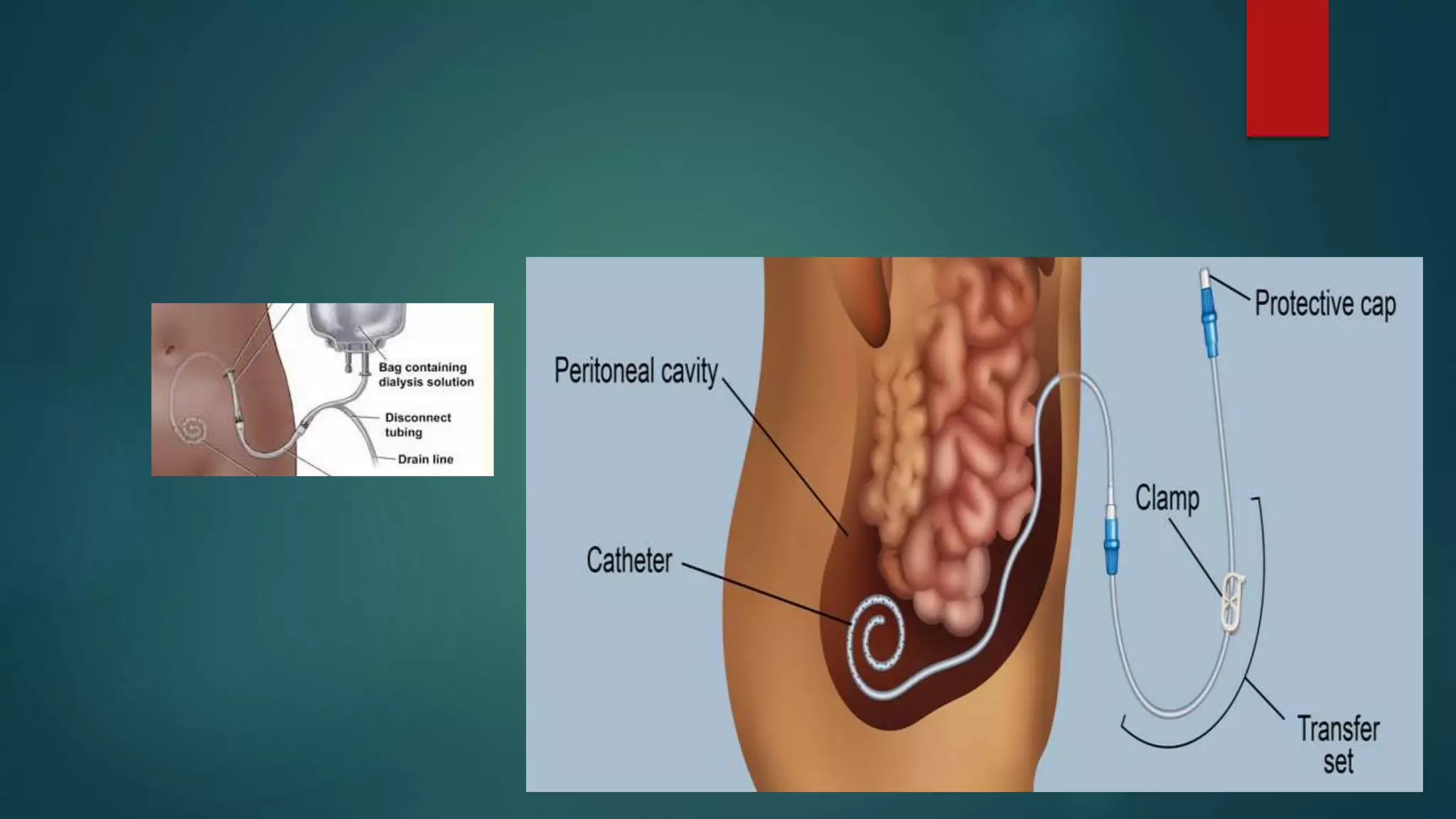Renal system management | PPTX