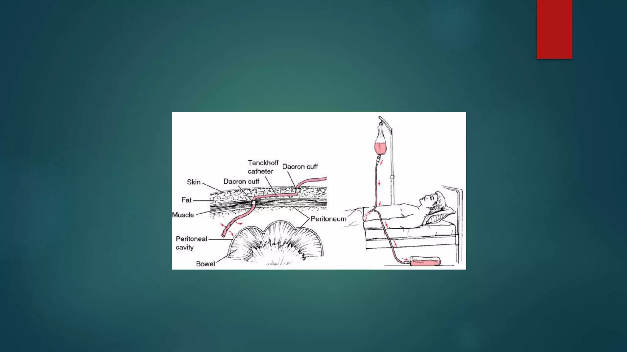 Renal system management | PPTX