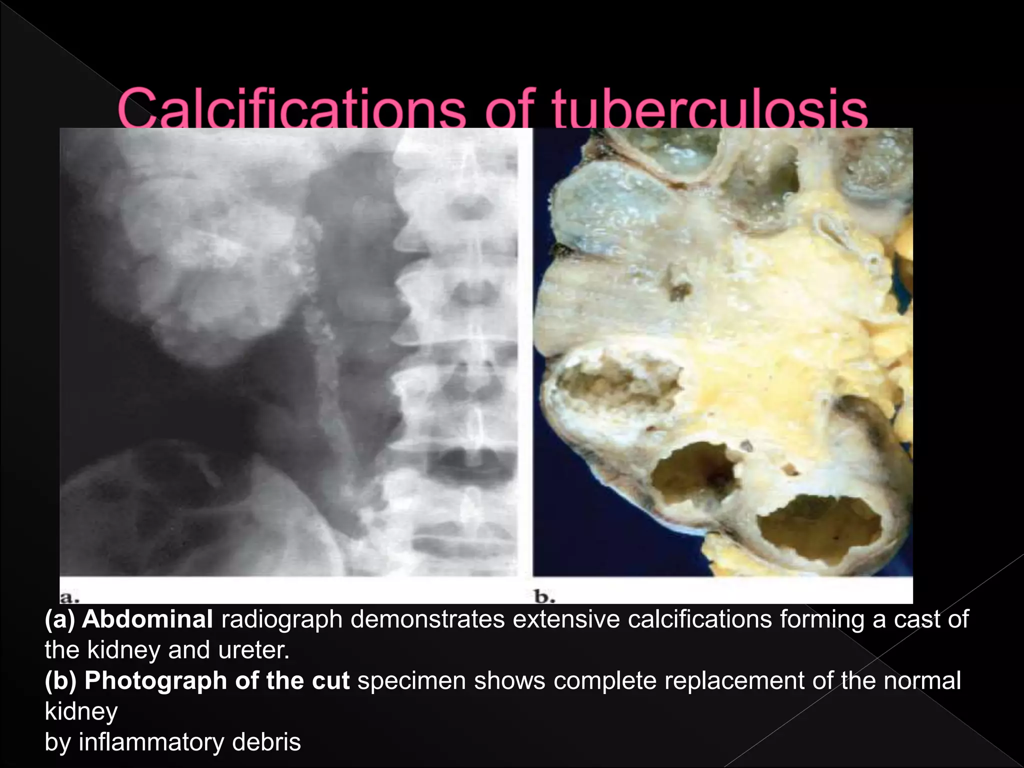 Renal tuberculosis radiology | PPTX