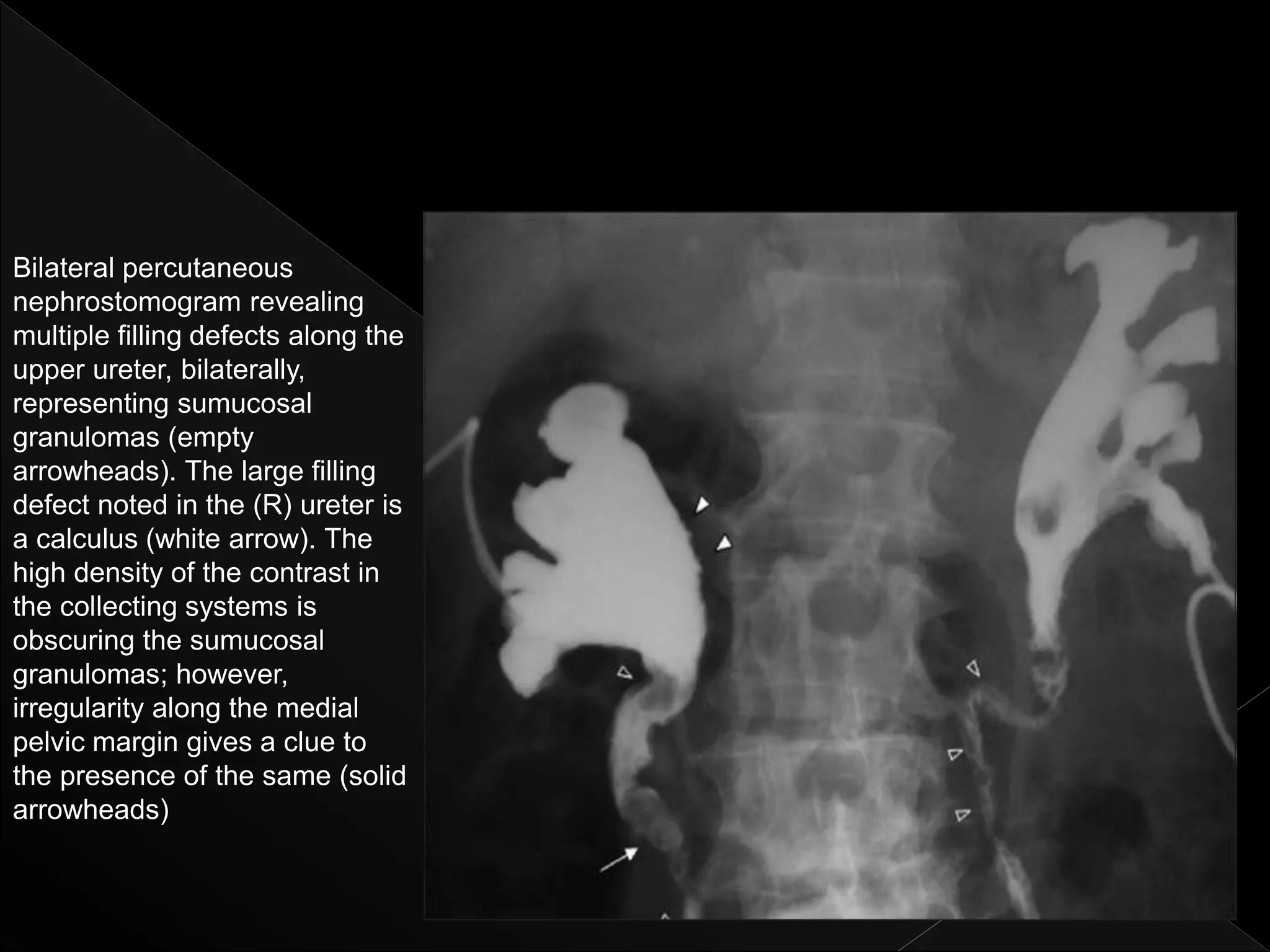 Renal tuberculosis radiology | PPTX