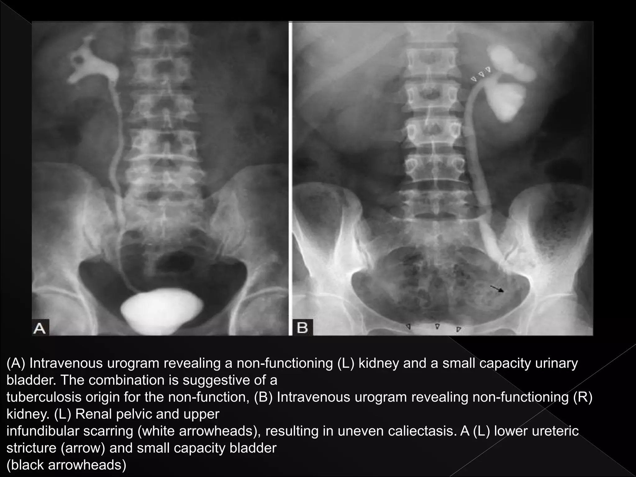 Renal tuberculosis radiology | PPTX
