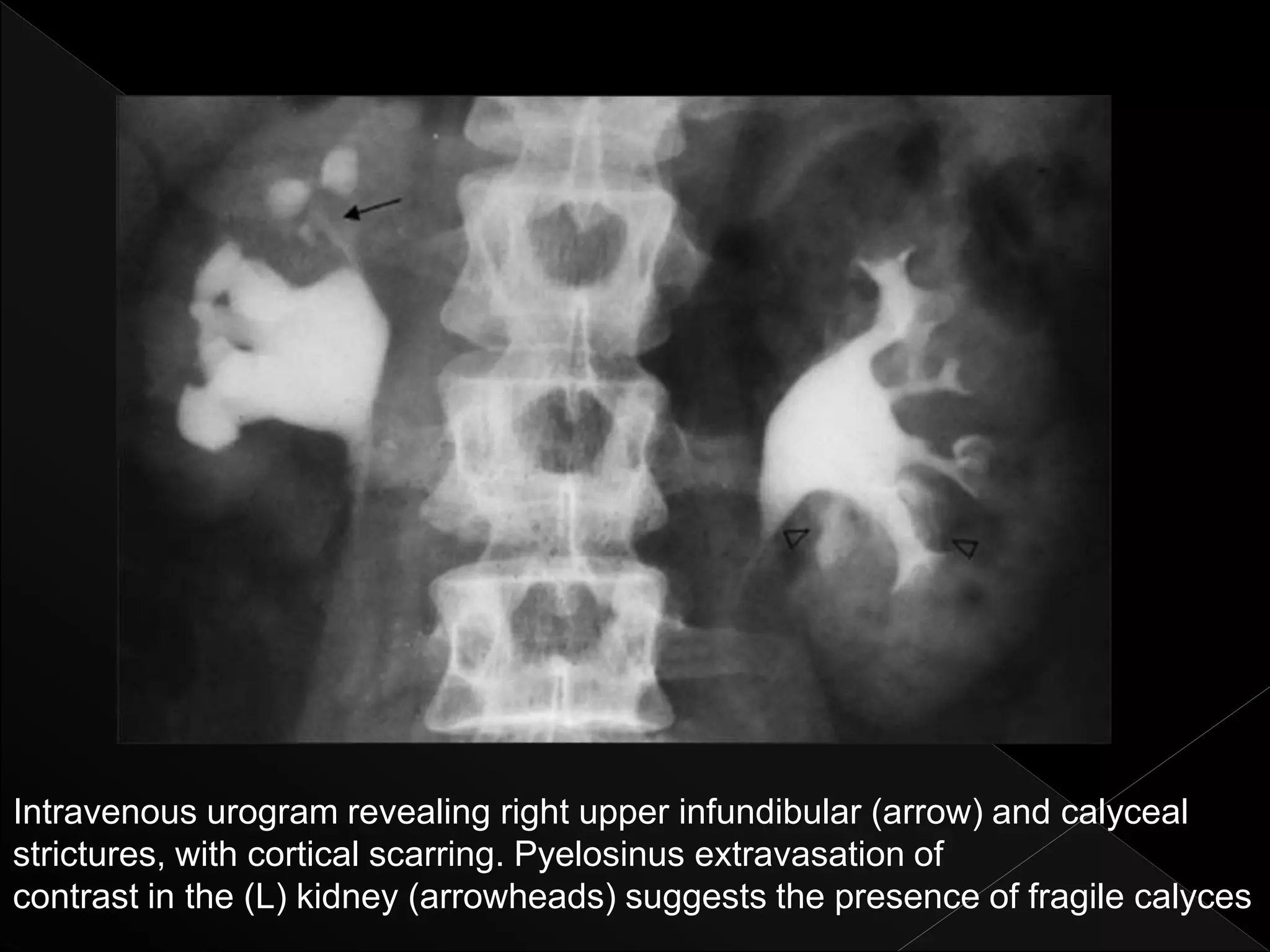 Renal tuberculosis radiology | PPTX