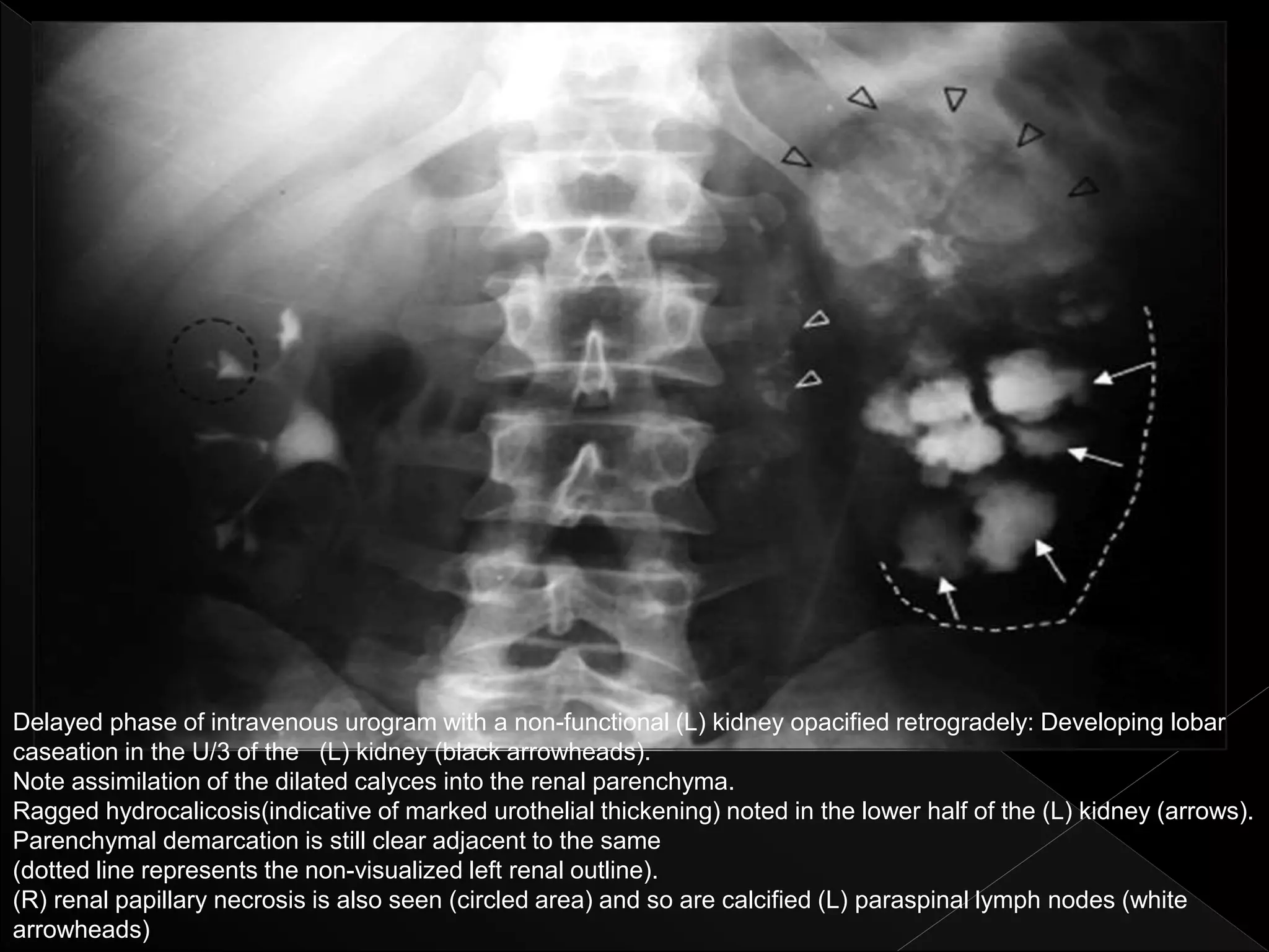 Renal tuberculosis radiology | PPTX