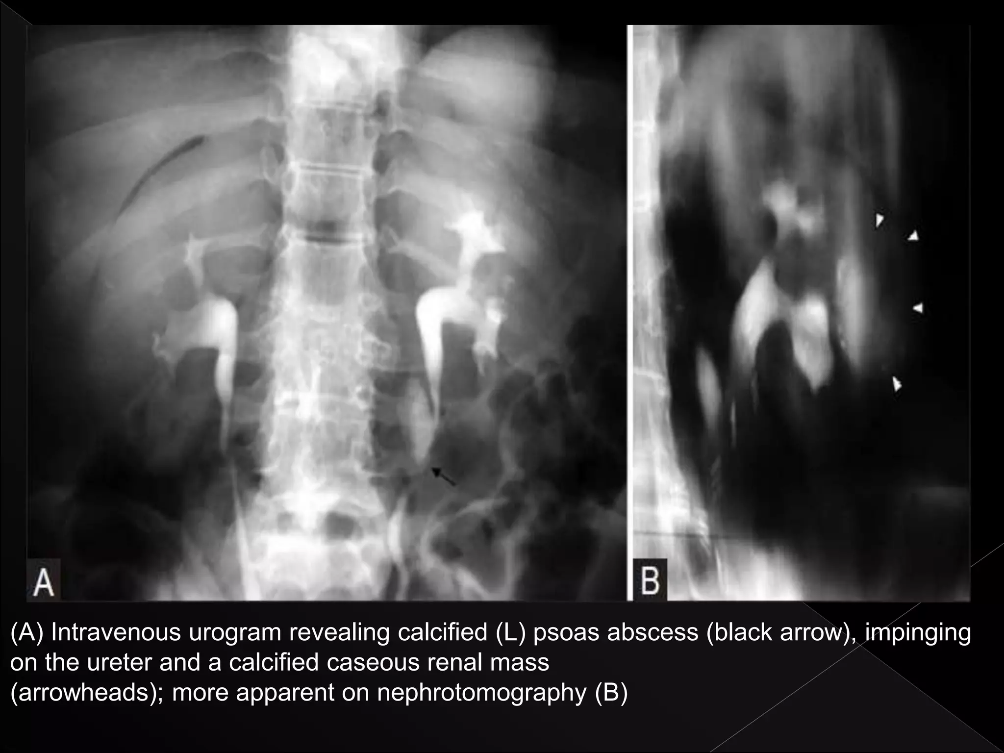Renal tuberculosis radiology | PPTX