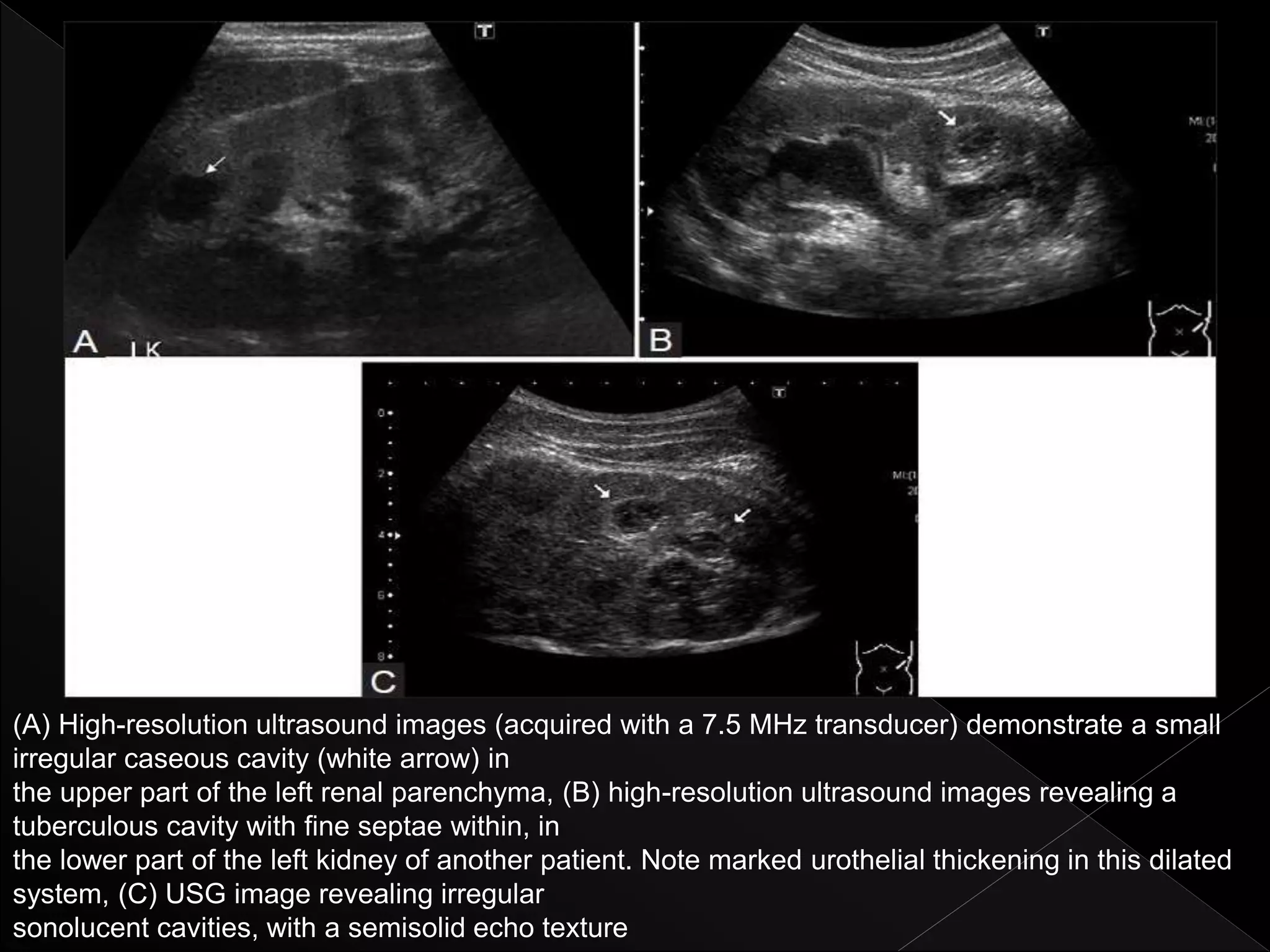 Renal tuberculosis radiology | PPTX