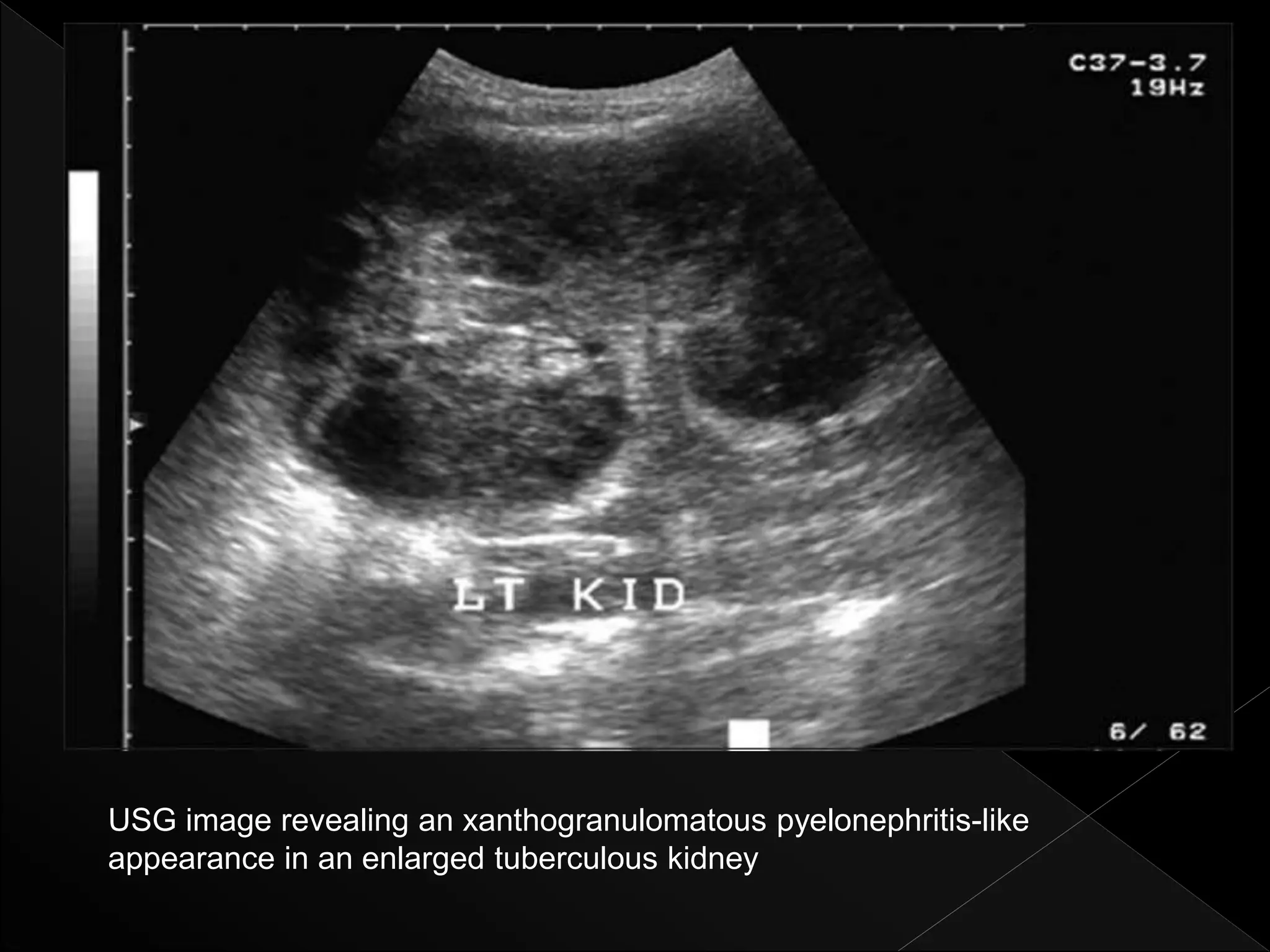 Renal tuberculosis radiology | PPTX