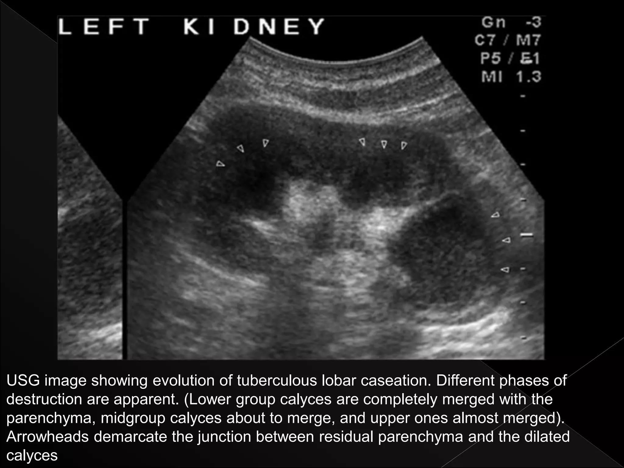 Renal tuberculosis radiology | PPTX