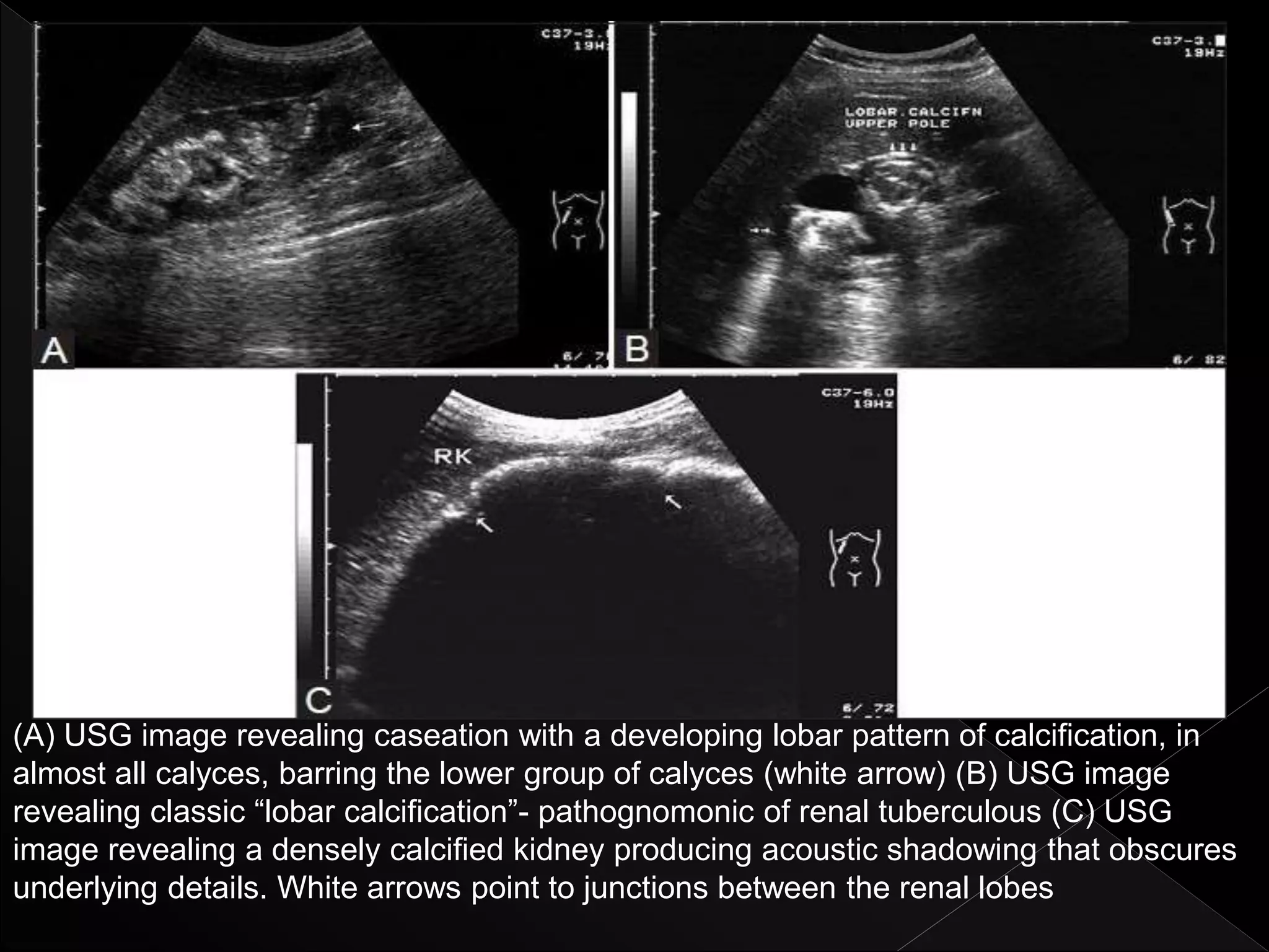 Renal tuberculosis radiology | PPTX