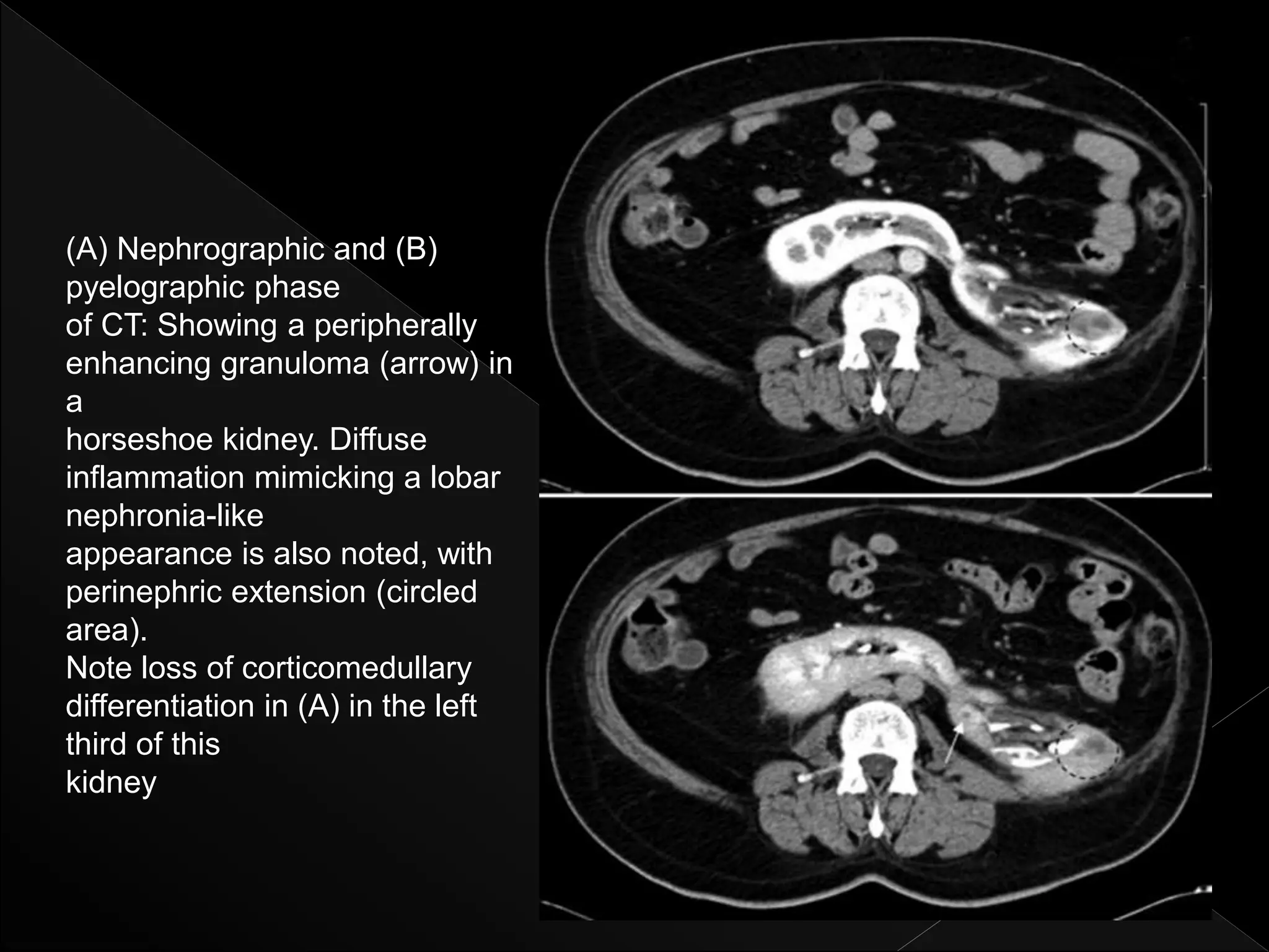 Renal tuberculosis radiology | PPTX