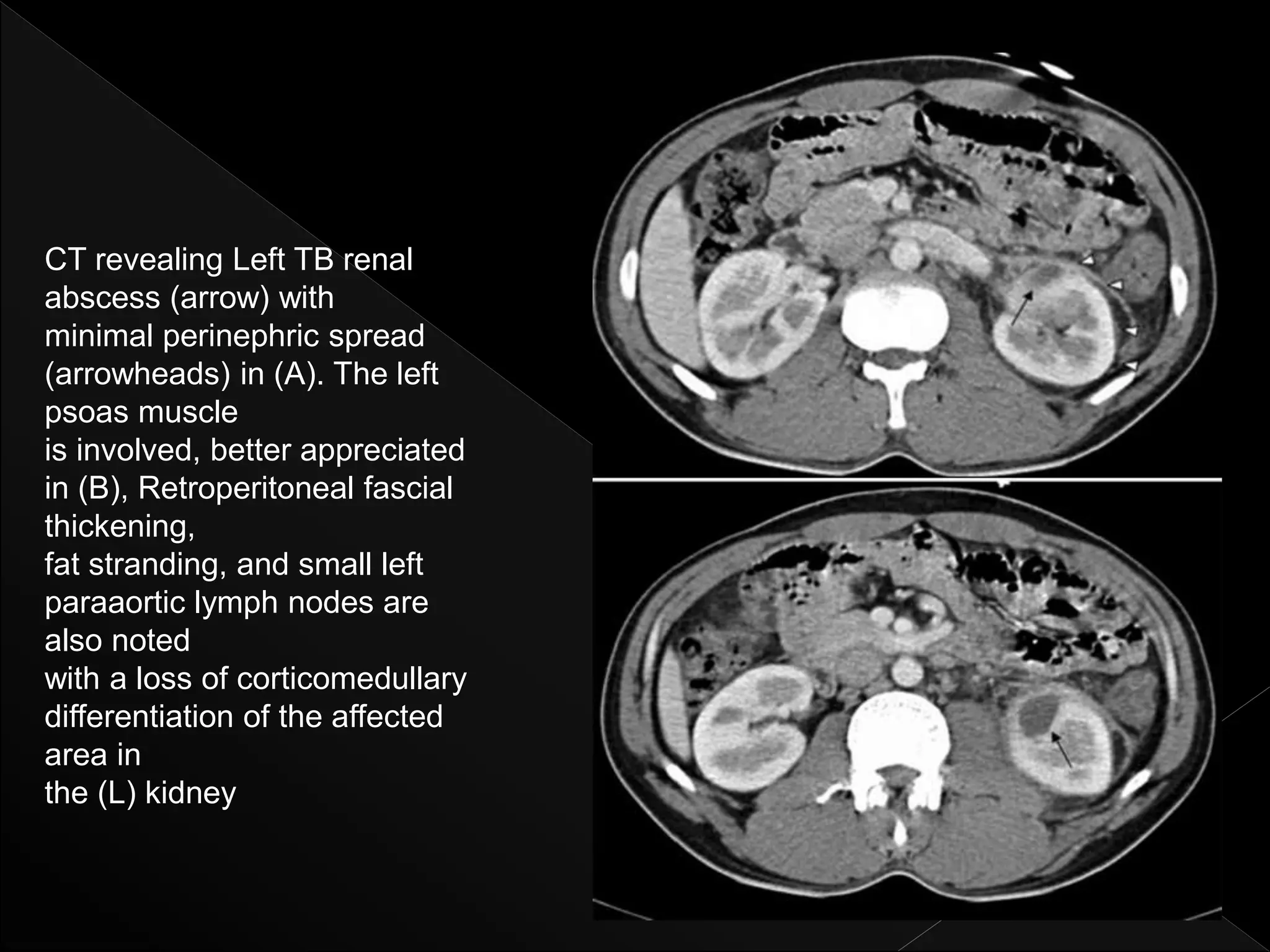 Renal tuberculosis radiology | PPTX
