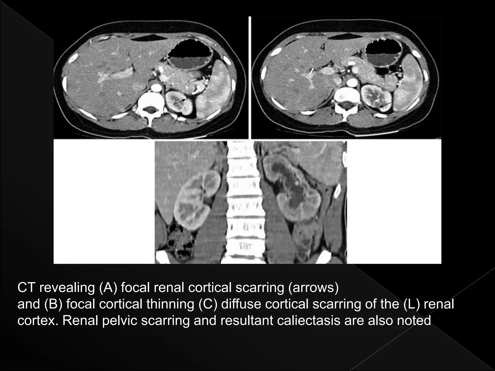Renal tuberculosis radiology | PPTX
