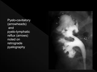 Renal tuberculosis radiology | PPTX