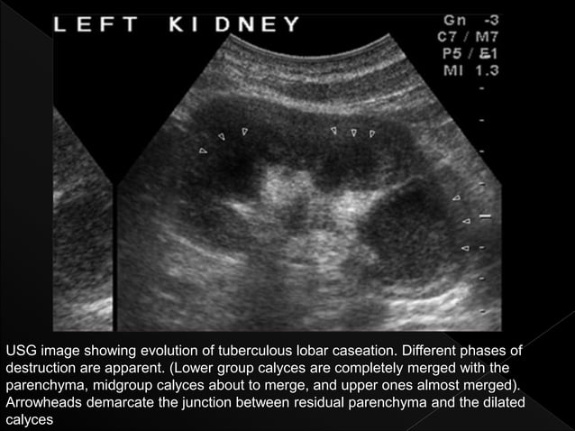 Renal tuberculosis radiology | PPTX | Medical Tests | Medical Health