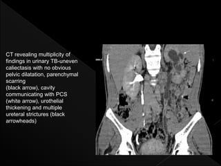 Renal tuberculosis radiology | PPTX