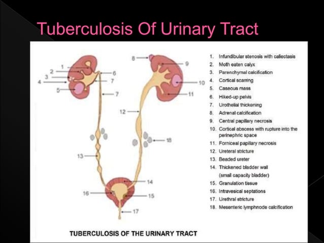 Renal tuberculosis radiology | PPTX | Medical Tests | Medical Health