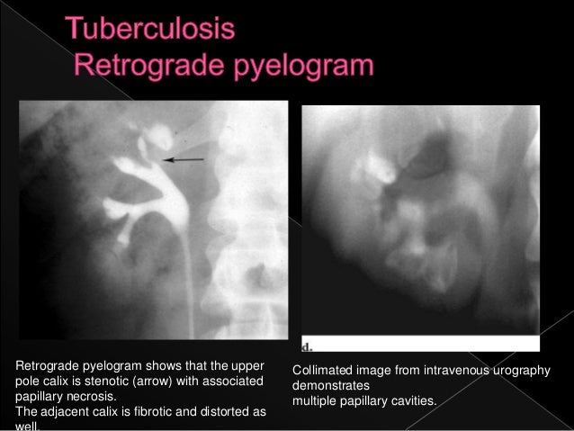 Renal tuberculosis radiology