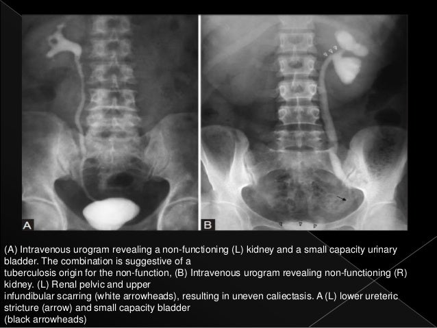 Renal tuberculosis radiology