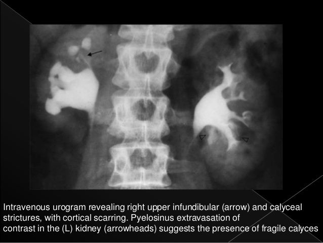 Renal tuberculosis radiology