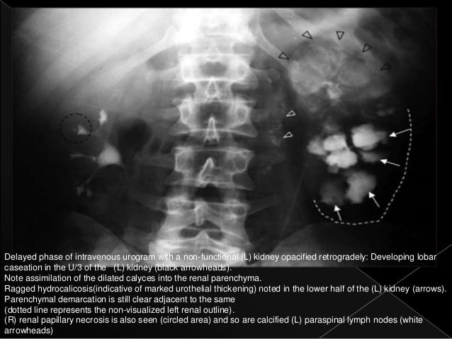 Renal tuberculosis radiology