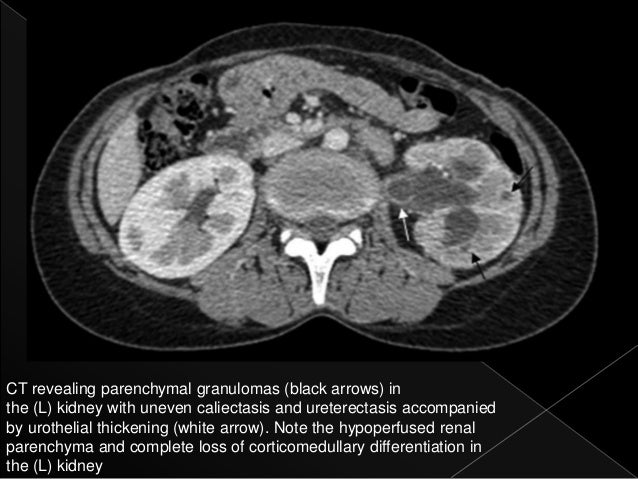Renal tuberculosis radiology