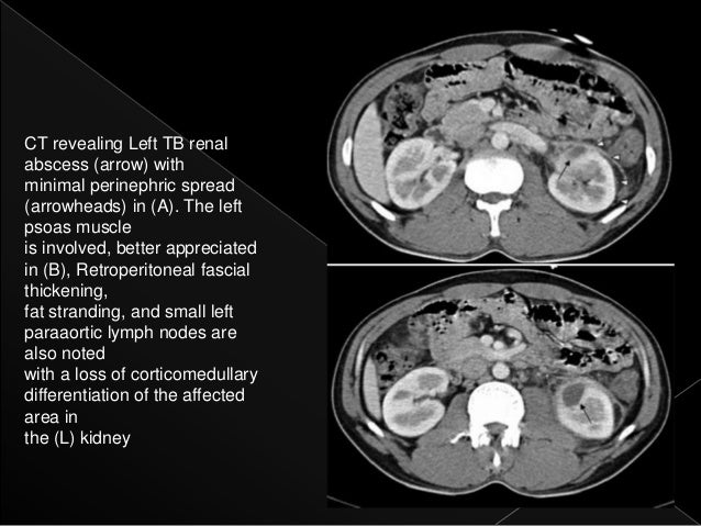 Renal tuberculosis radiology
