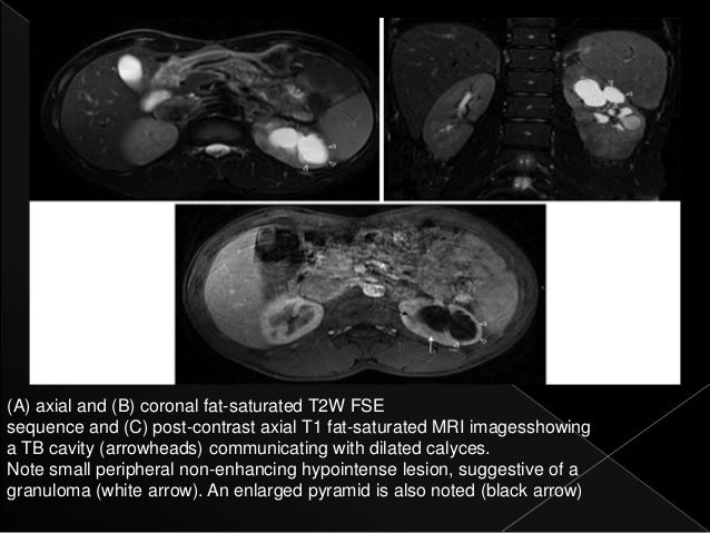 Renal tuberculosis radiology