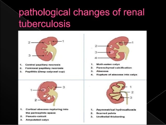 Renal tuberculosis radiology
