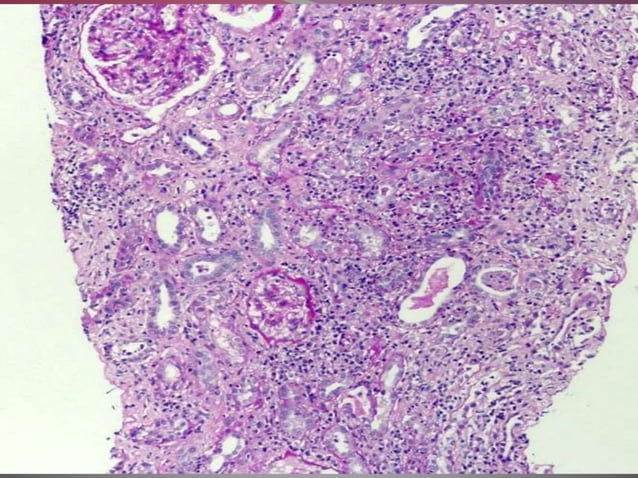 Renal Tuberculosis - Kidney and tubercular manifestations | PPTX