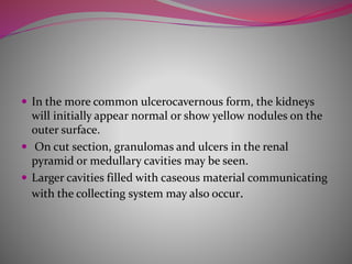 Renal Tuberculosis - Kidney and tubercular manifestations | PPTX