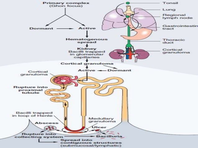 Renal Tuberculosis - Kidney and tubercular manifestations | PPTX