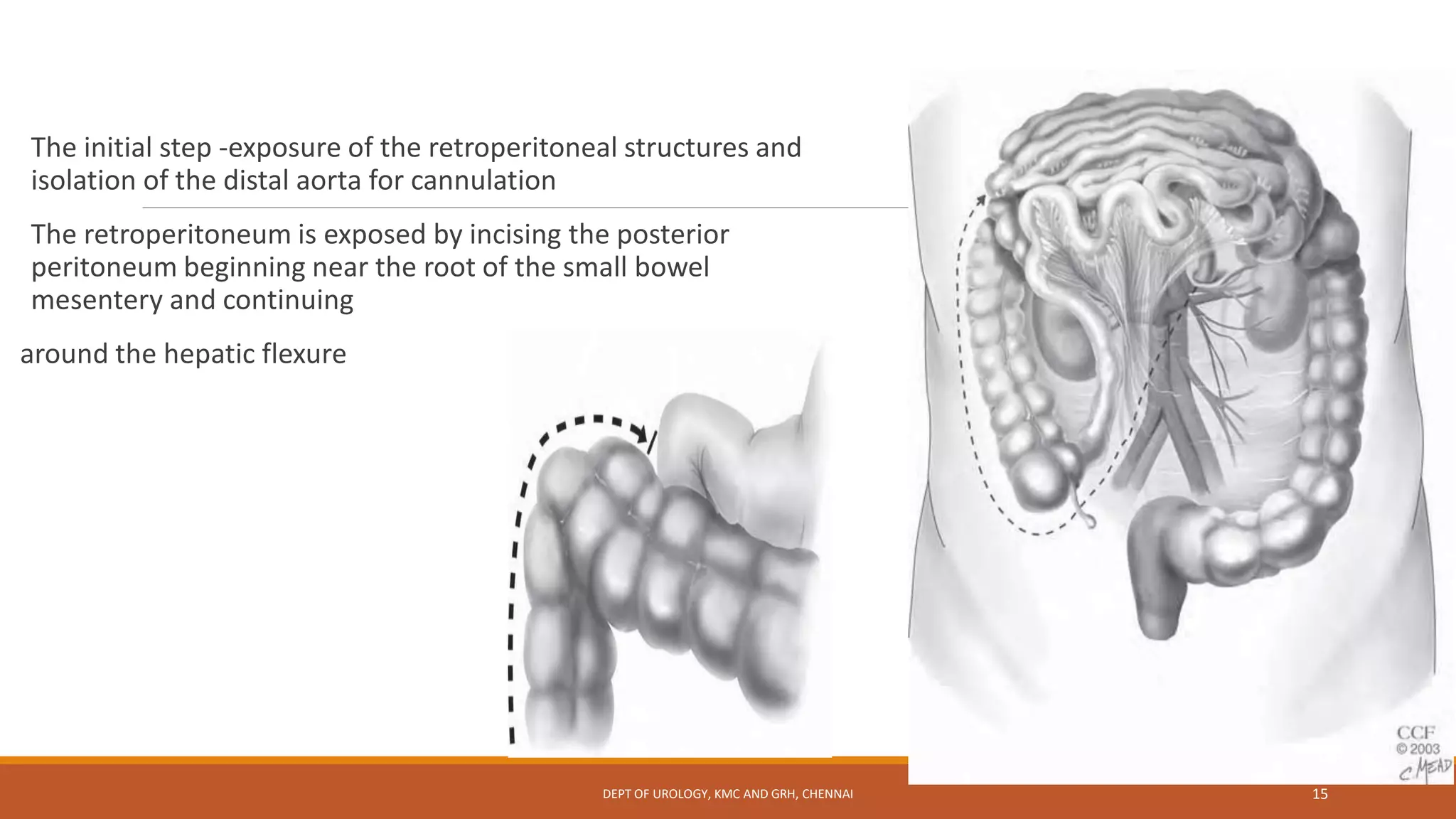 Renal transplant donor- nephrectomy | PDF