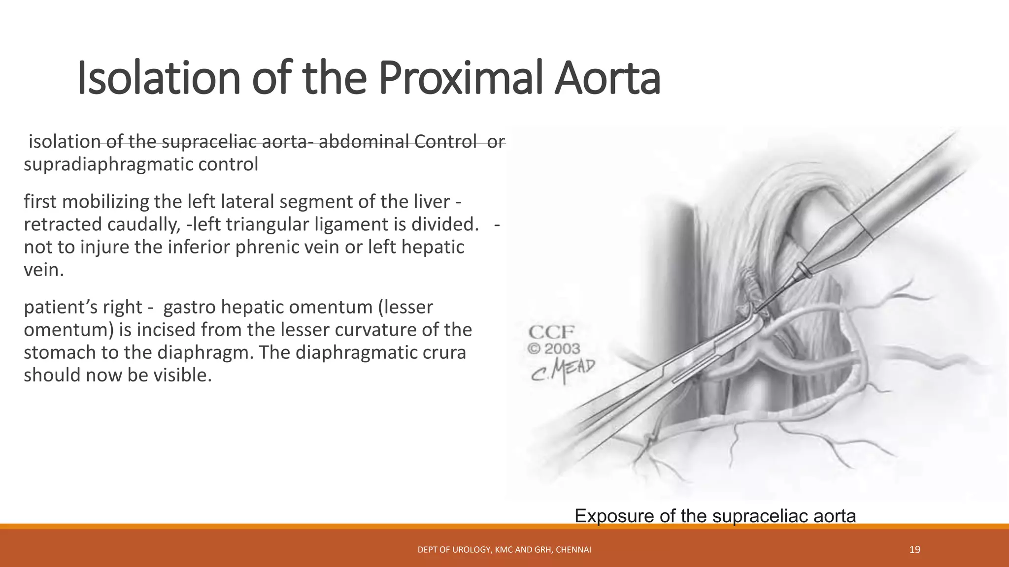 Renal transplant donor- nephrectomy | PDF