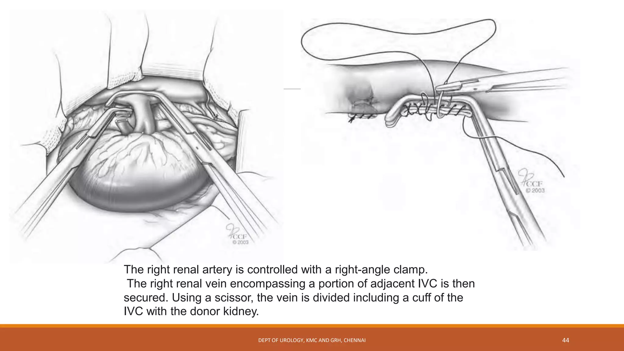 Renal transplant donor- nephrectomy | PDF