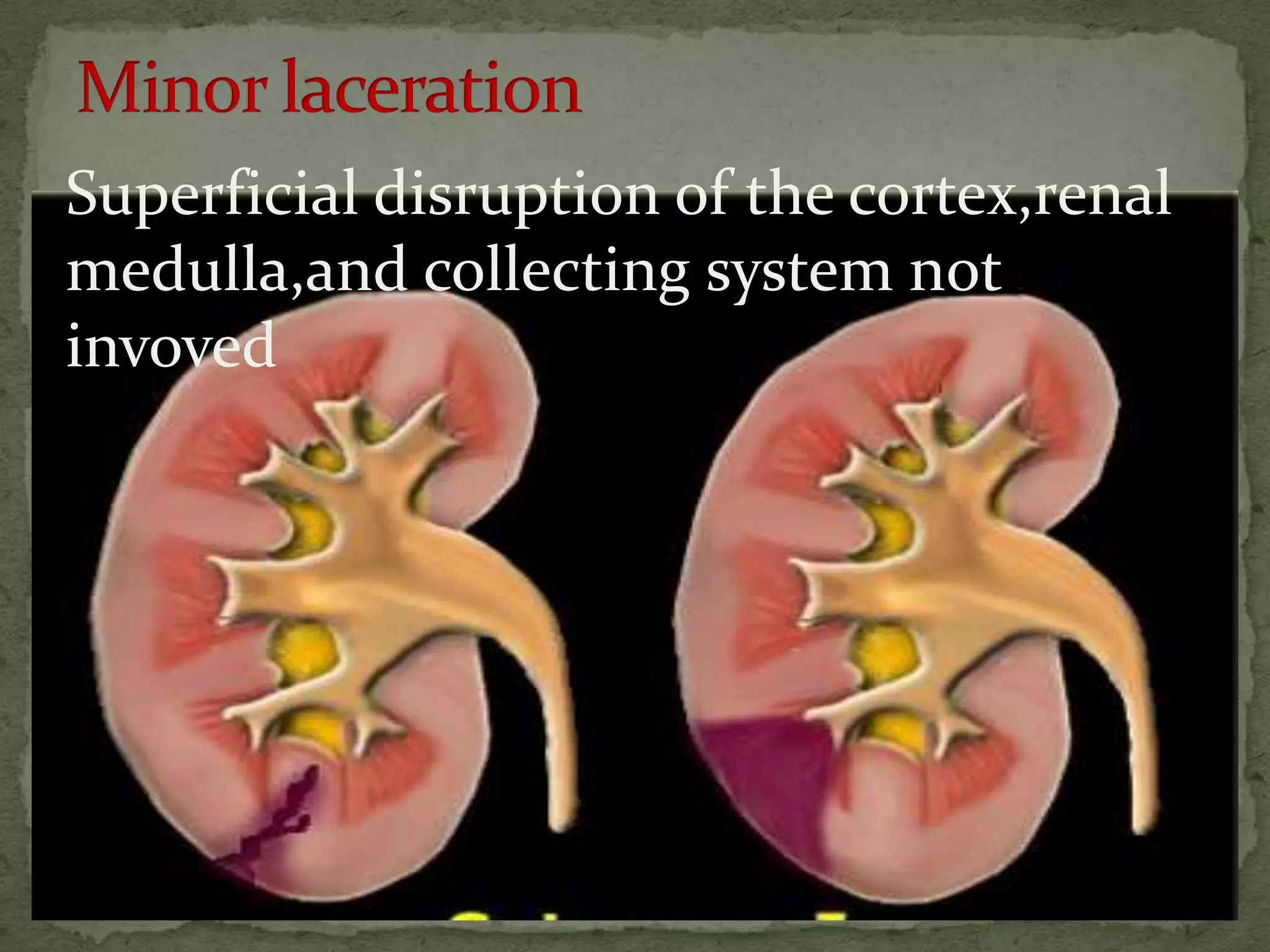 RENAL TRAUMA-FOR NEPHRO - UROLOGY STUDENTS | PPTX