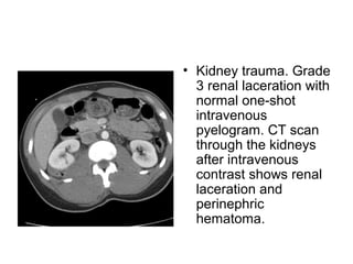 Renal trauma | PPT