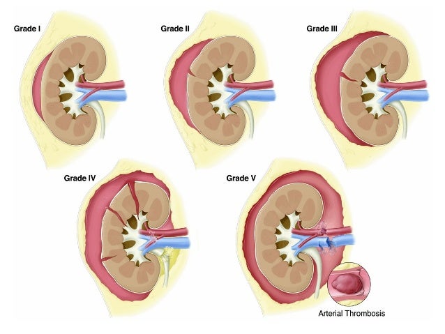 Renal trauma