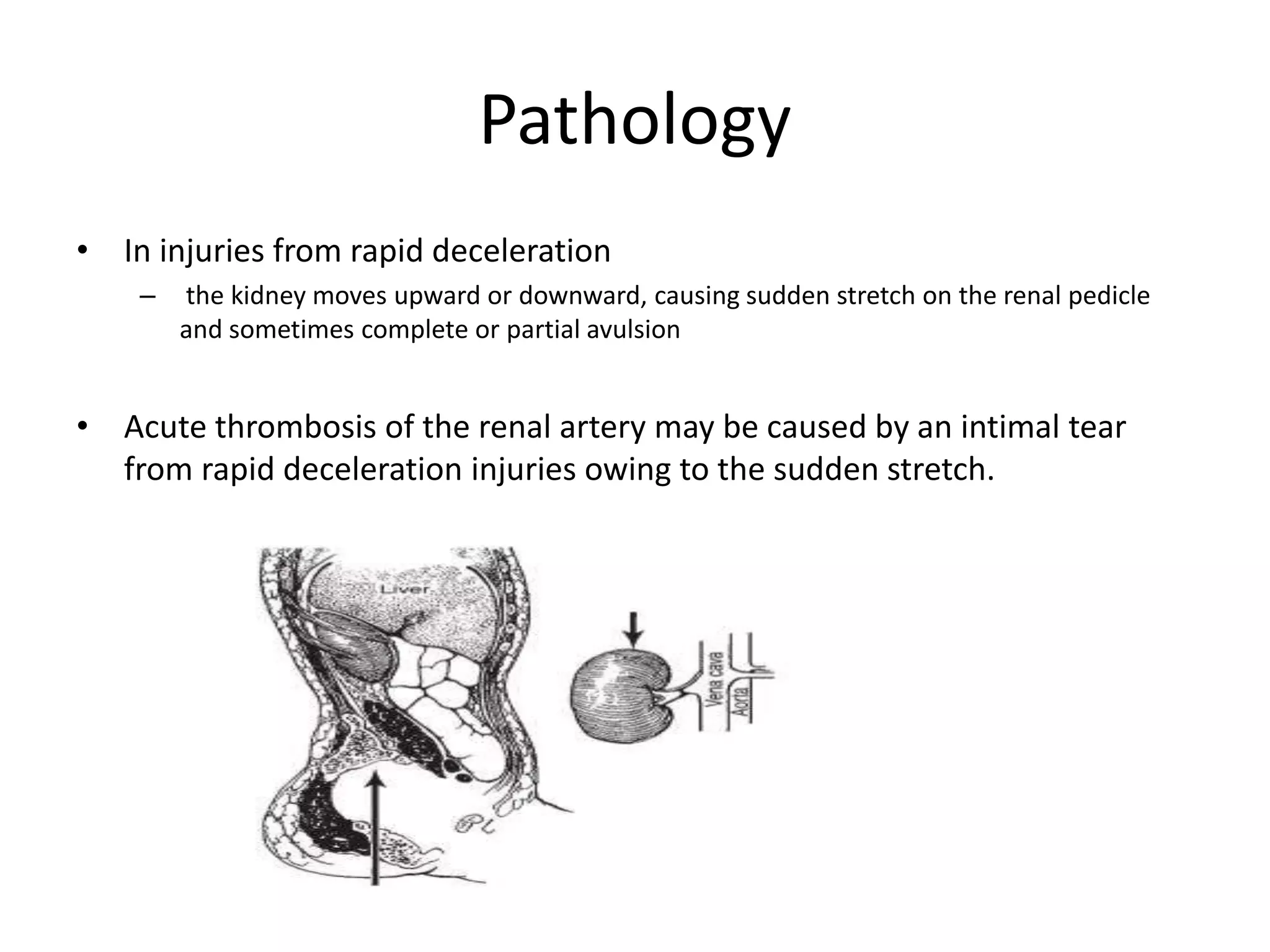 Renal trauma | PPTX