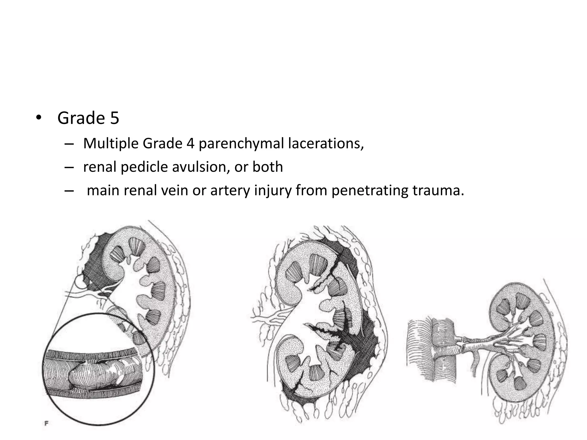 Renal trauma | PPTX