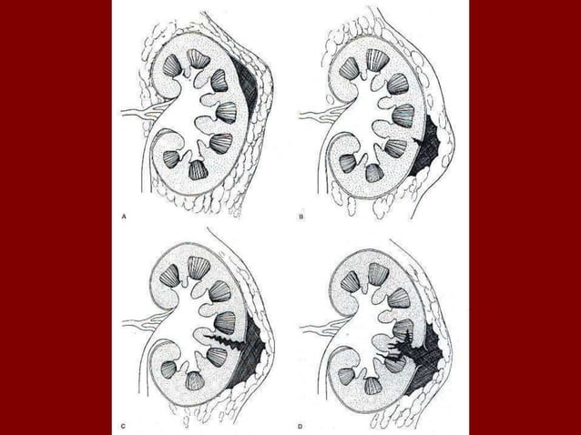 abdominal trauma and renal trauma injury.pptx